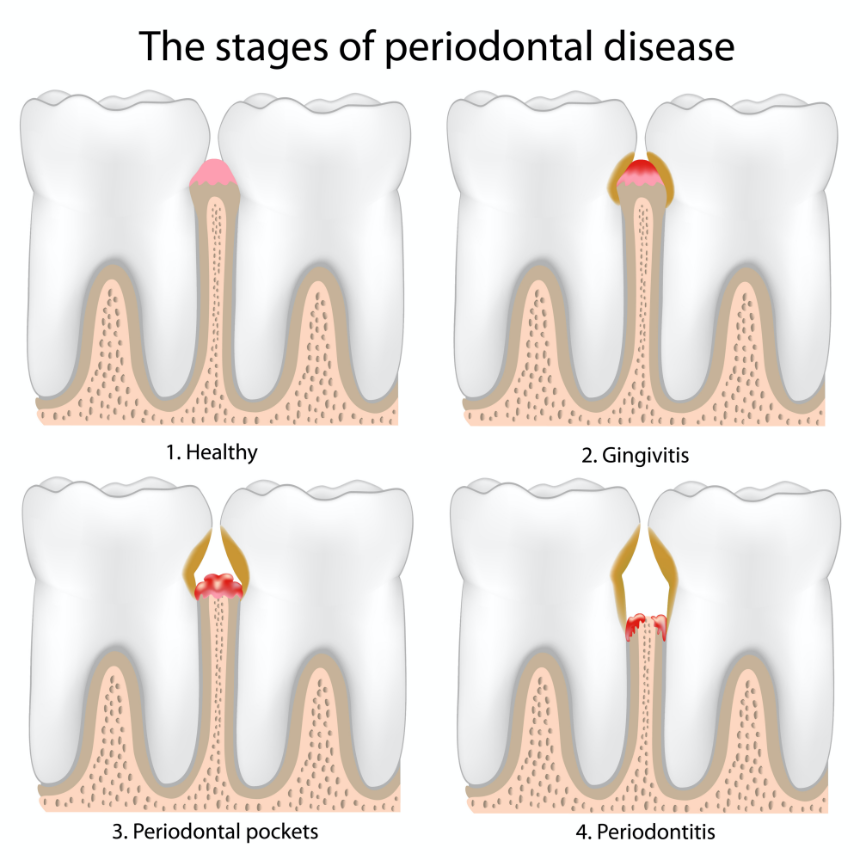 Periodontal (Gum) Disease - Oakdale Family Dental