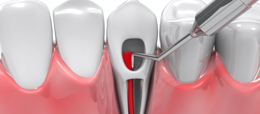 Endodontics Root Canal - Oakdale Family Dental
